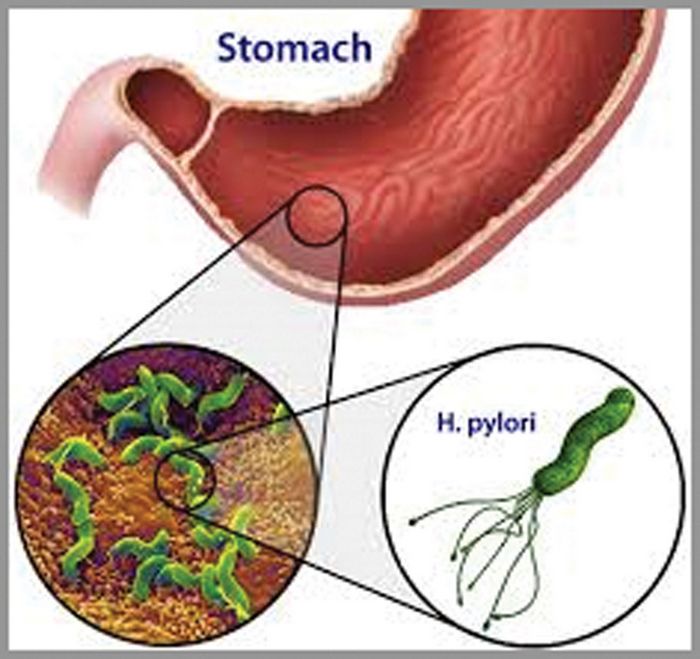 Helicobacter Pylori Infection | Ipoh Echo