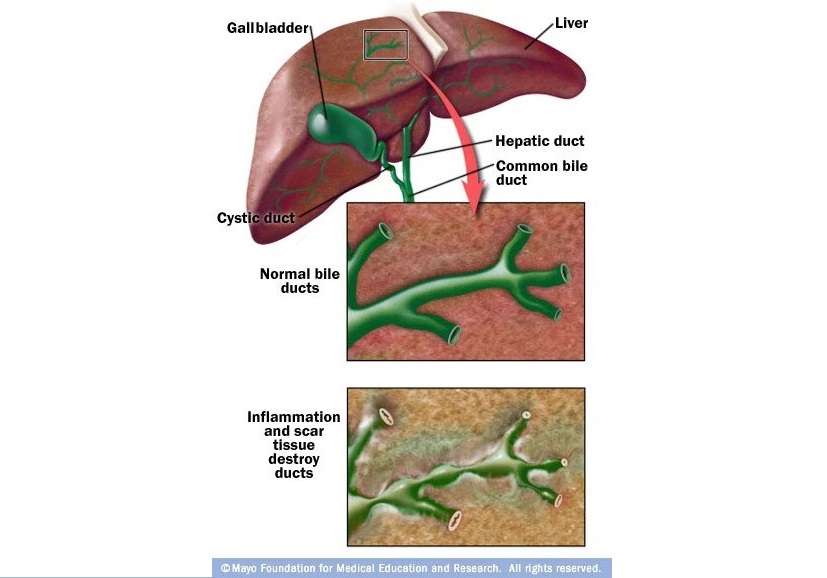 Primary Biliary Cirrhosis | Ipoh Echo