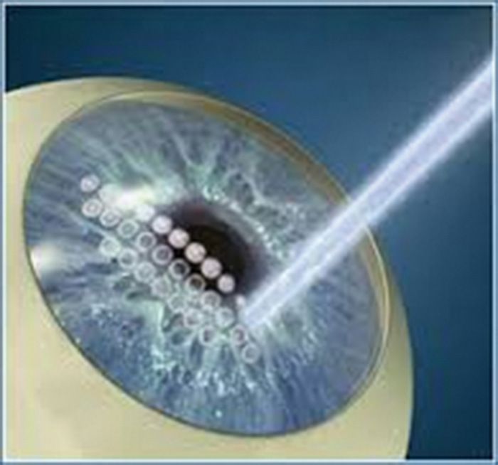 About Lasik: Brief History of Refractive Surgery | Ipoh Echo