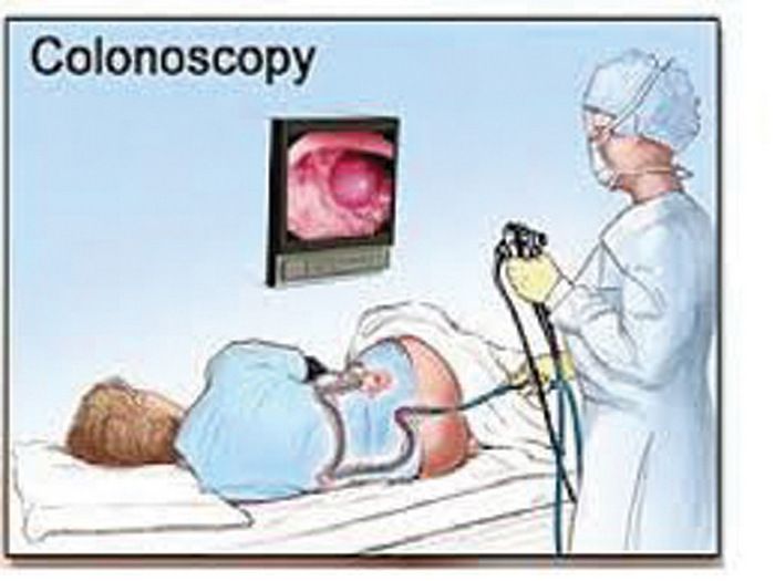 Colon Cancer Prevention: Colonoscopy | Ipoh Echo